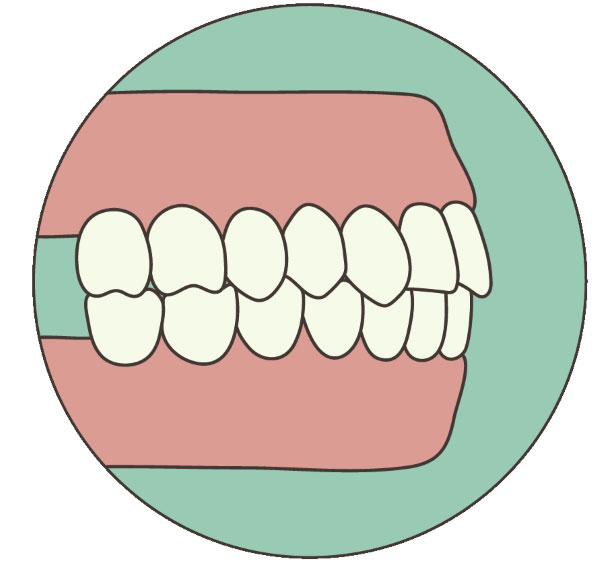 Can Invisalign® Fix Overbite: Before & After Results