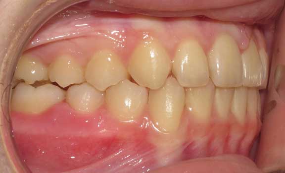 Invisalign® Before and After: Real Patients Results