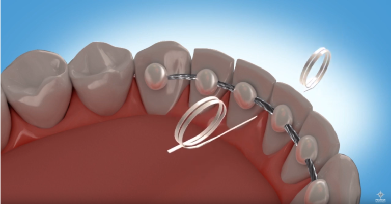 How to Floss with a Permanent Retainer?