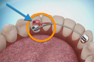 Permanent Retainer Broke? Causes, What to Do & Repair Costs