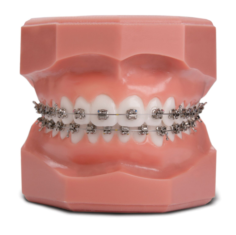 Self-Ligating Braces: What Are They, Benefits & Costs