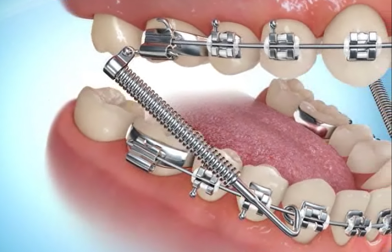 Forsus Springs - A Patient's Guide - Premier Orthodontics
