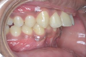 How Do Braces Fix Overbites? - Premier Orthodontics