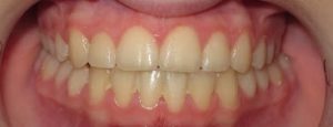 How Do Braces Fix Crossbites?
