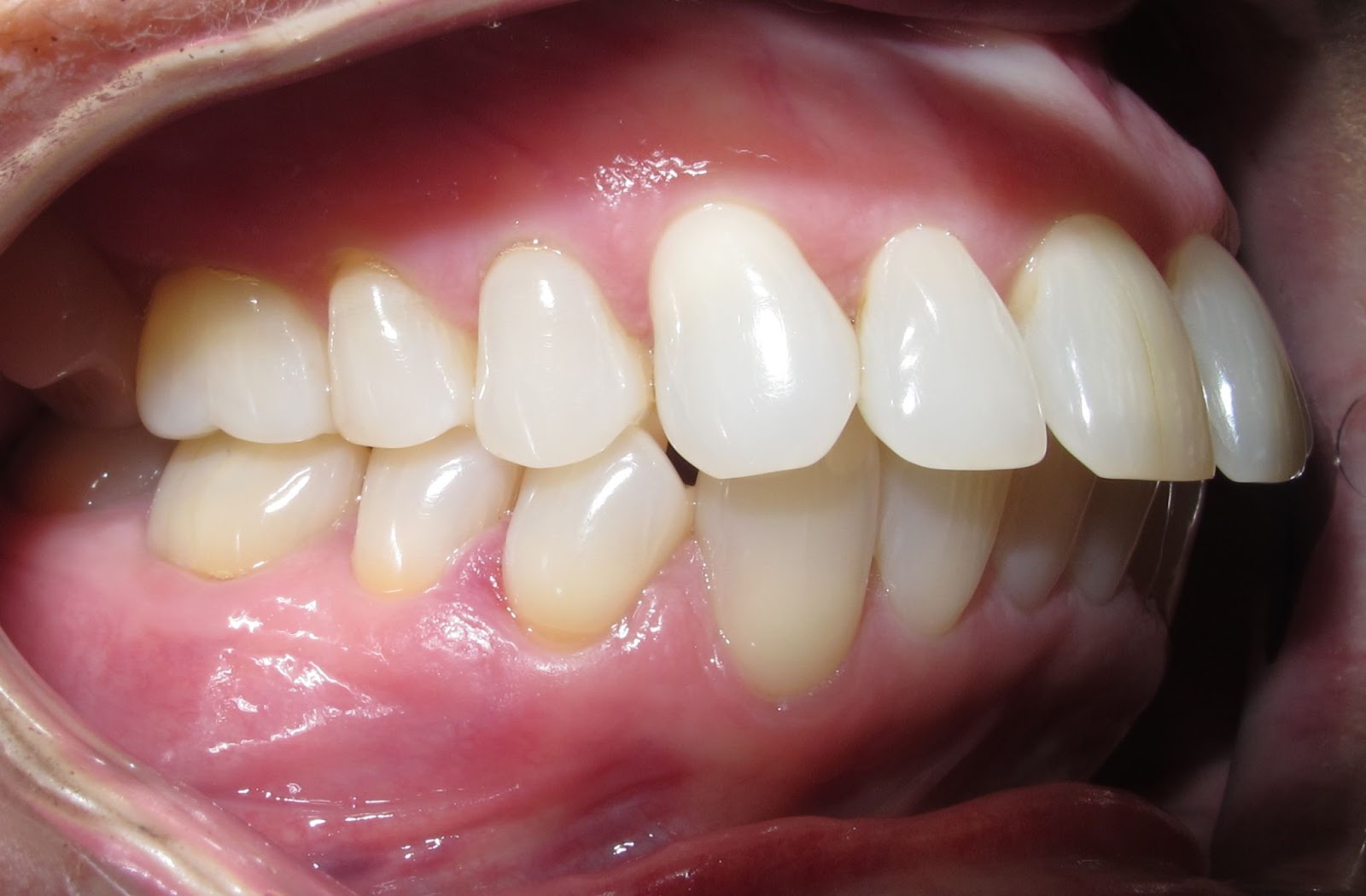Can Invisalign® Fix Crossbite? Before & After Real Results