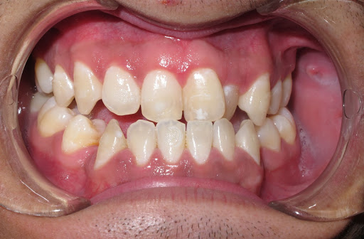 Can Invisalign® Fix Crossbite? Before & After Real Results