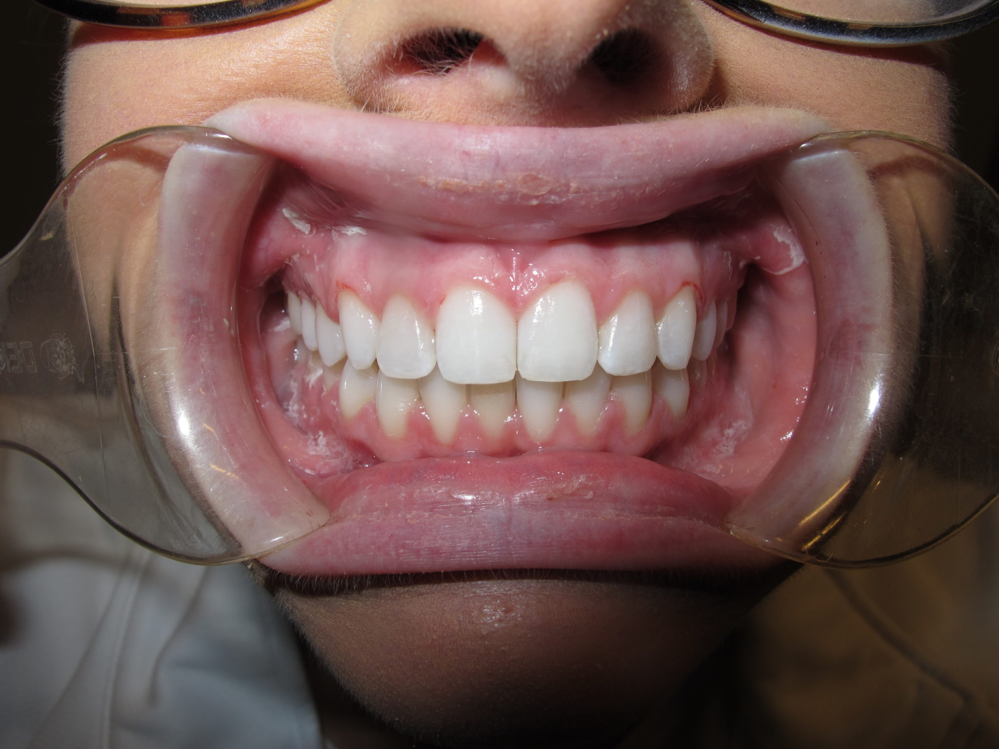 Can Invisalign® Fix Deep Bites? Before & After Real Results