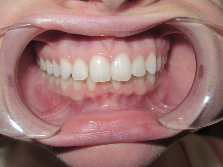 Can Invisalign® Fix Deep Bites? Before & After Real Results