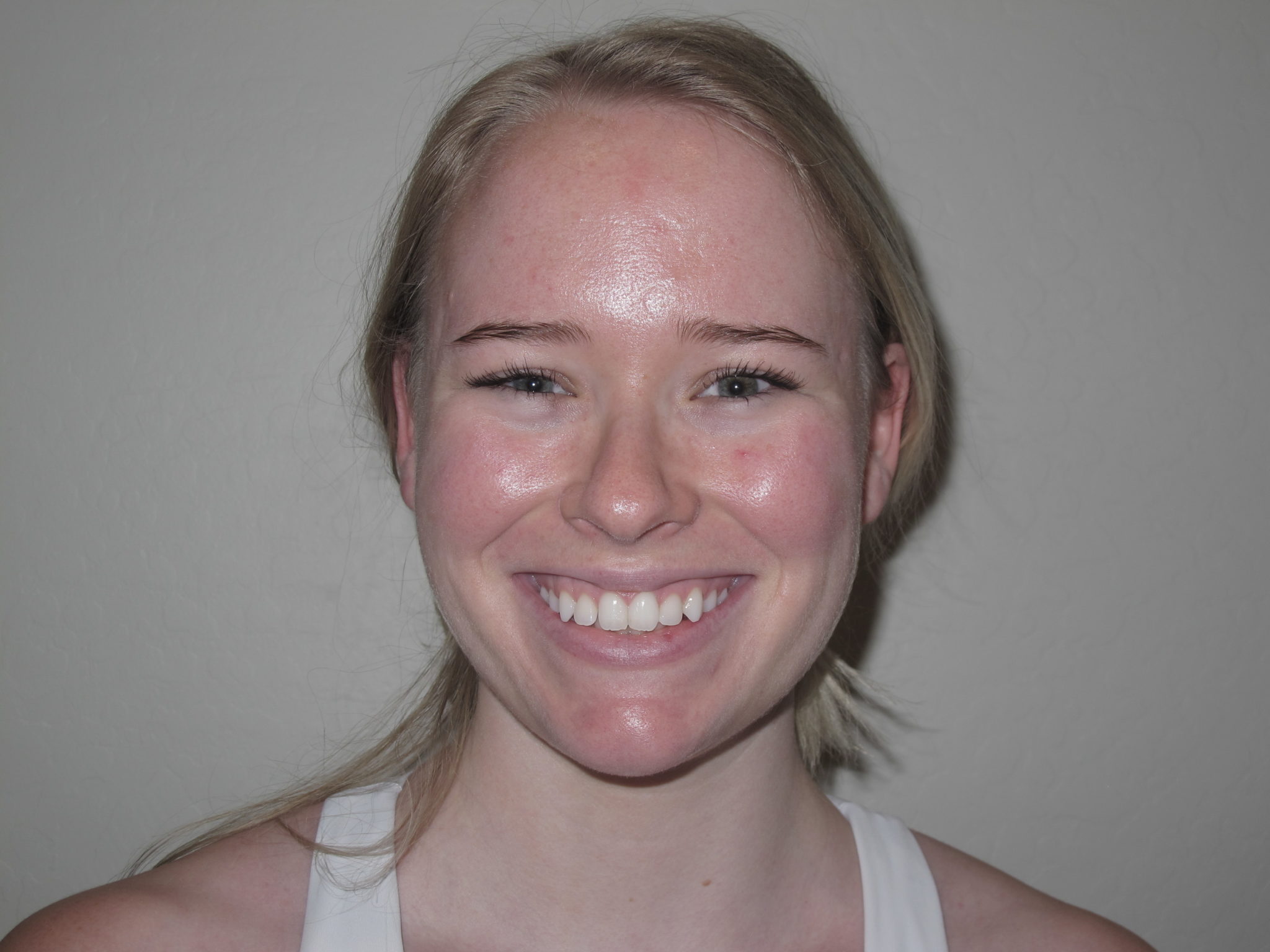 Can Invisalign® Fix Deep Bites? Before & After Real Results