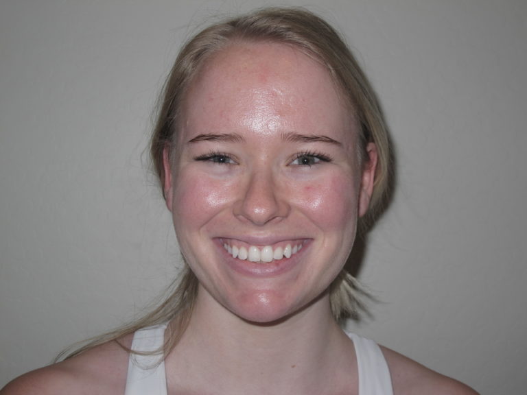 Can Invisalign® Fix Deep Bites? Before & After Real Results