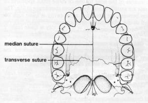 The Complete Guide to Palate Expanders and Braces