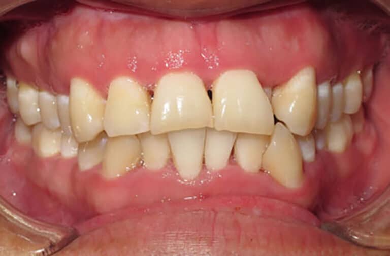 Getting Adult Braces: Types, Treatment Timeline & Costs